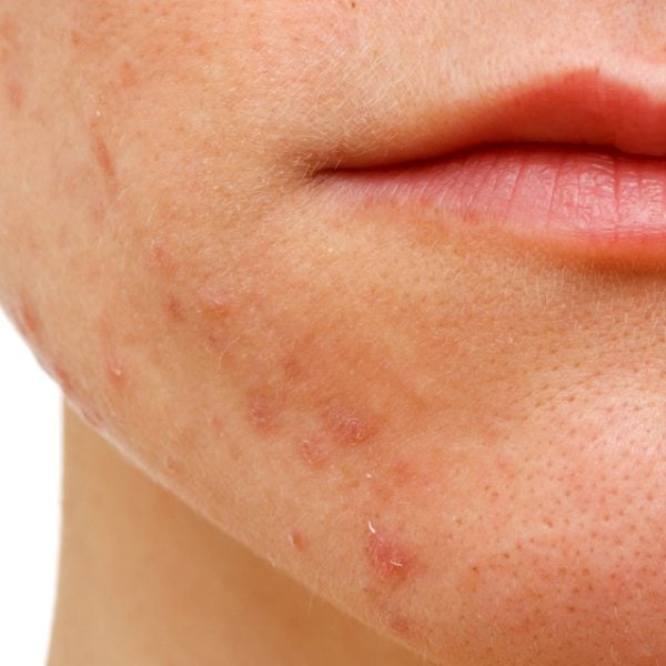 Dermatite viso: cos'è, cause, tipologie e come curarla